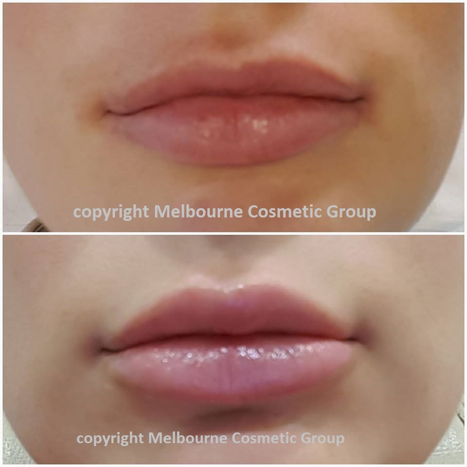 Lip Enhancement – Melbourne Cosmetic Group